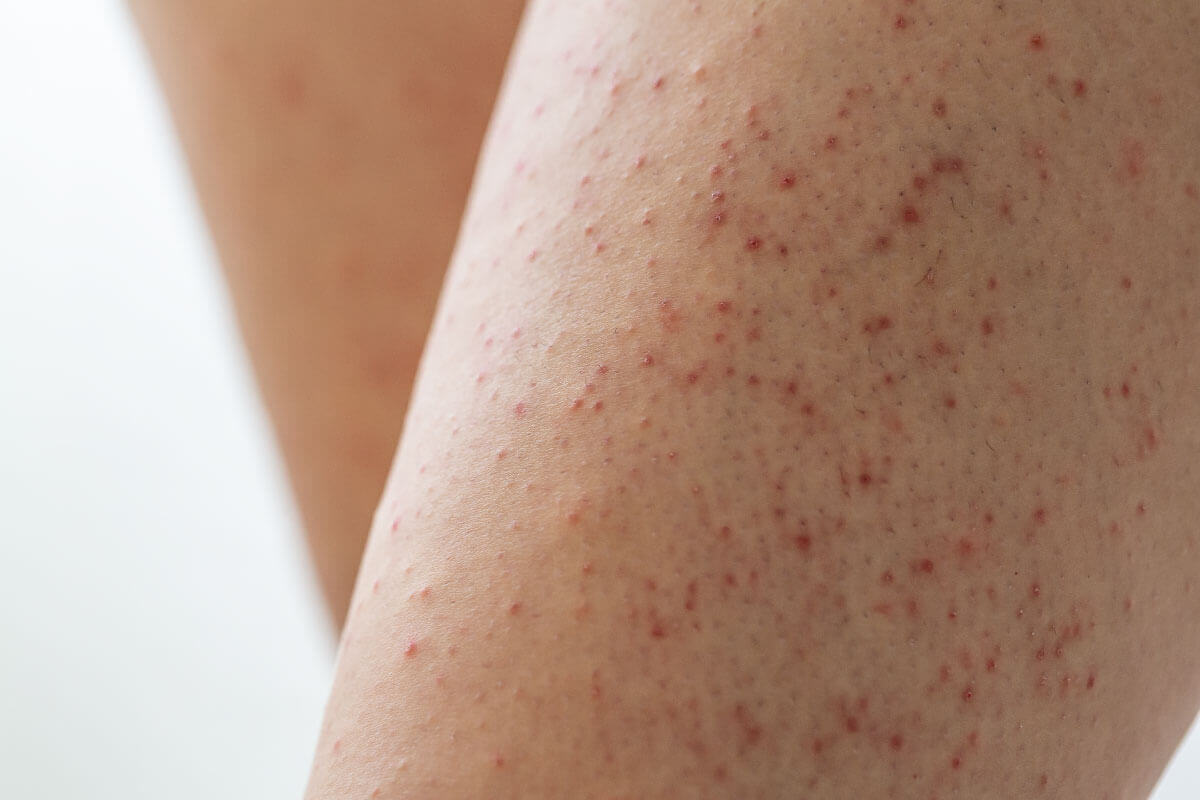 White Head Spots On Arms And Legs at Louis Lizotte blog